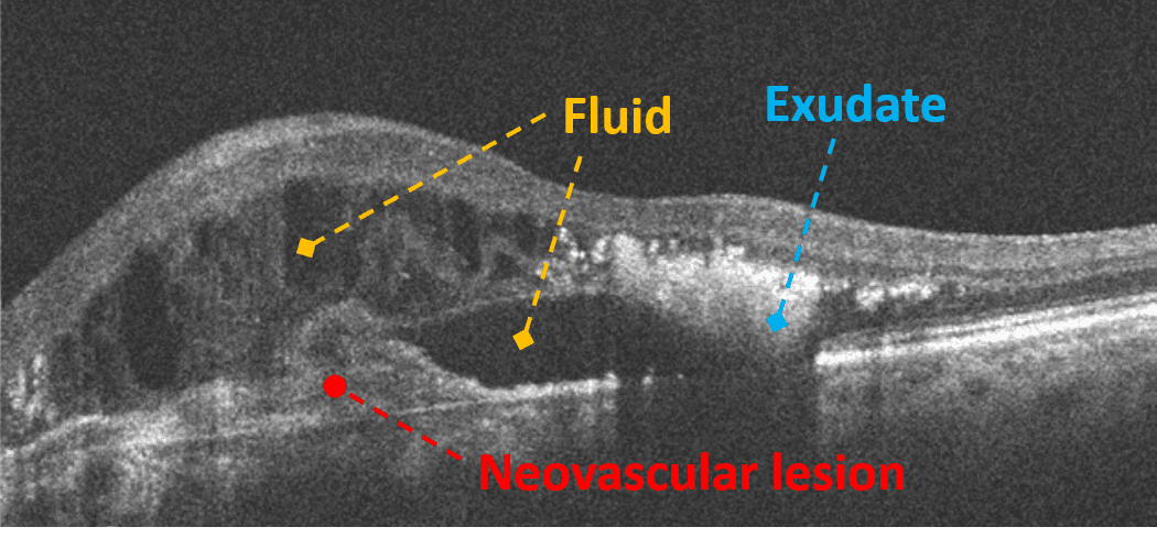 Age-Related Macular Degeneration: A Preamble