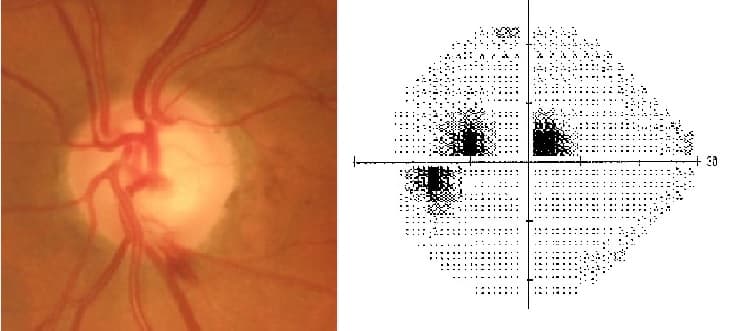 My Patient Has Optic Nerve Pallor: What Do I Do?