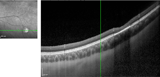 Differential Diagnosis for a Pigmented Fundus Lesion with Downloadable ...