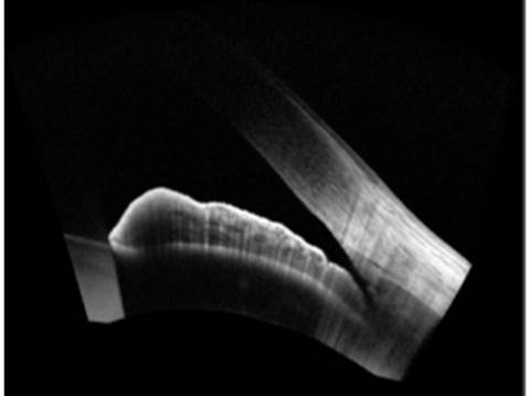 Utilizing OCT for Glaucoma Diagnosis and Management