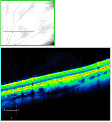 Differential Diagnosis for a Pigmented Fundus Lesion with Downloadable ...