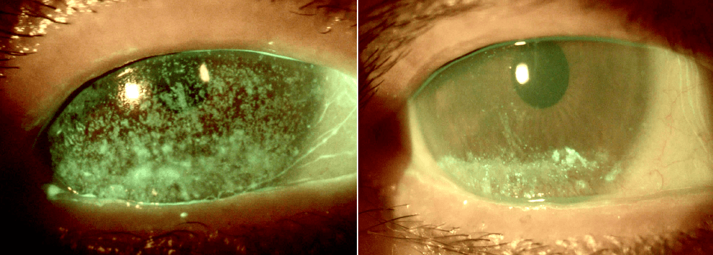 Using Platelet-Rich Plasma Eye Drops In Dry Eye Therapy