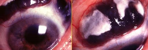 Conjunctivitis, Episcleritis, Scleritis, Oh My! with Differential ...