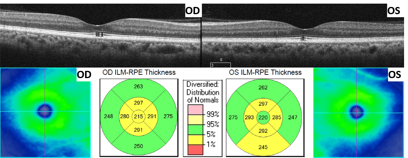 What to Know About Solar Retinopathy