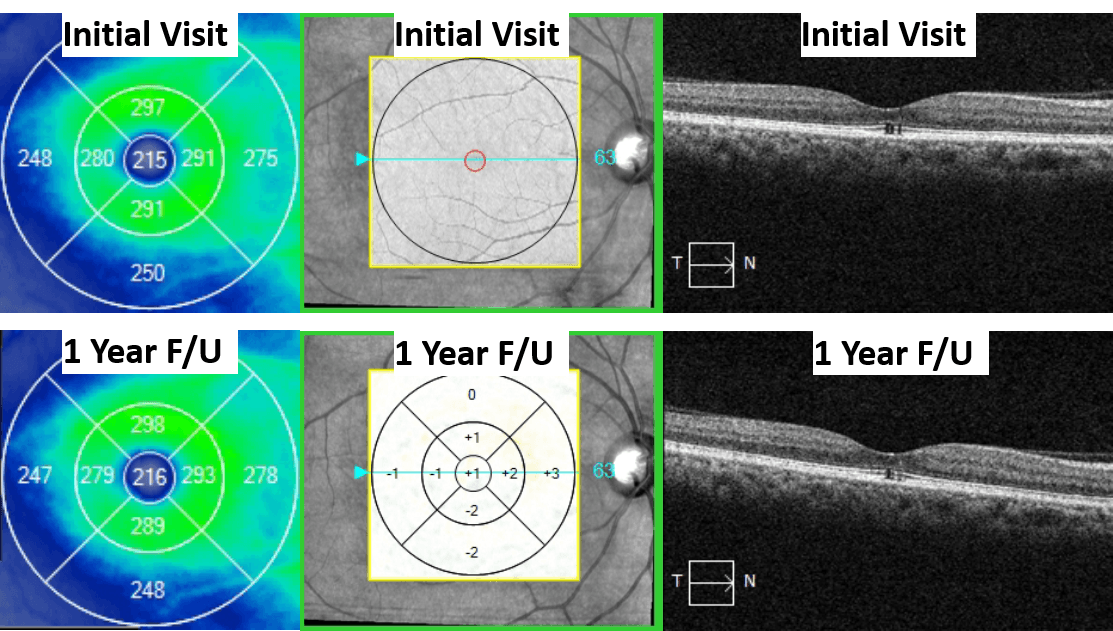 What to Know About Solar Retinopathy