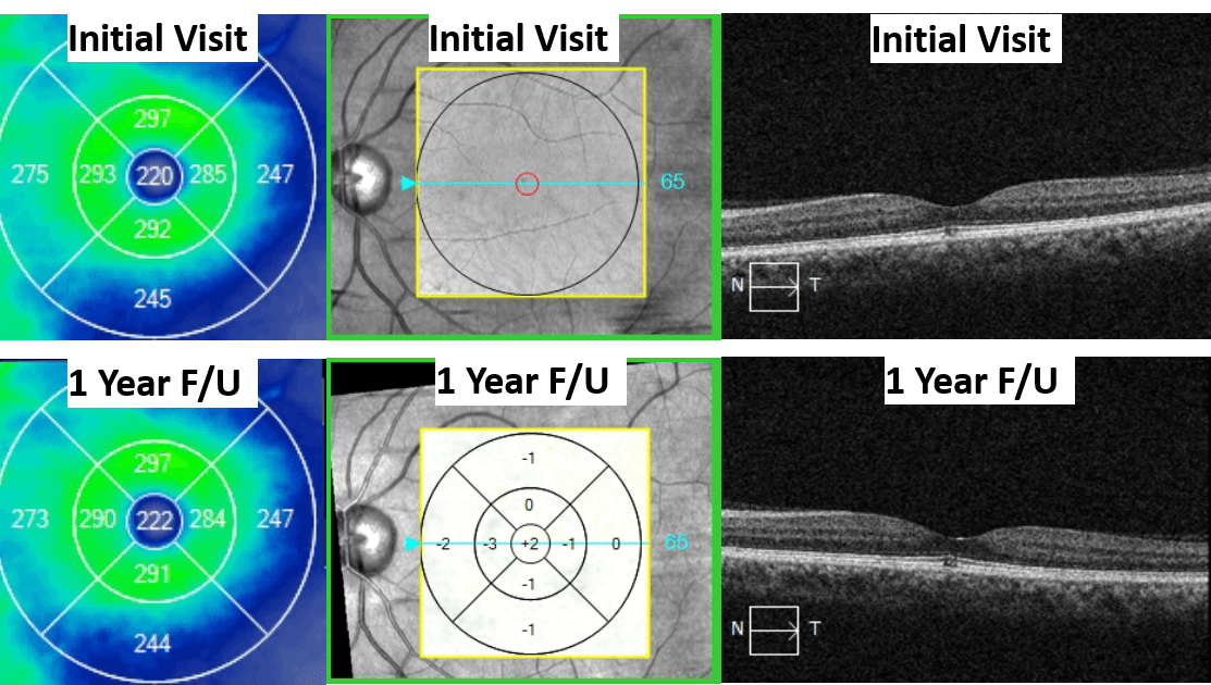What to Know About Solar Retinopathy