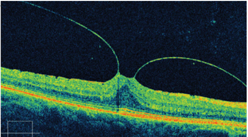 Guide to Common Macula Findings with OCT with Downloadable Cheat Sheet