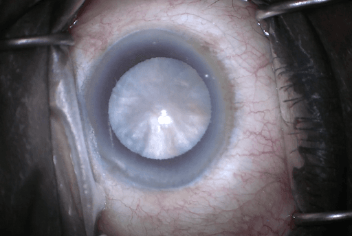 Case Report: The Challenges of White Cataracts
