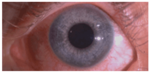What to Do About Contact Lens Overwear and Other Complications