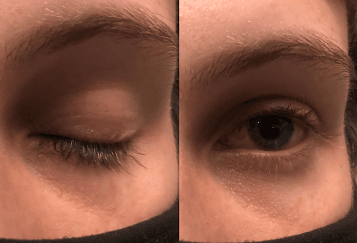 The Ultimate Guide to Conjunctivitis Differential Diagnosis
