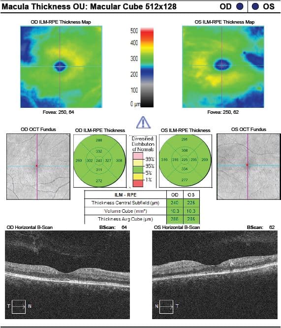 Ophthalmology Case Report: Simultaneous Bilateral Central Retinal ...
