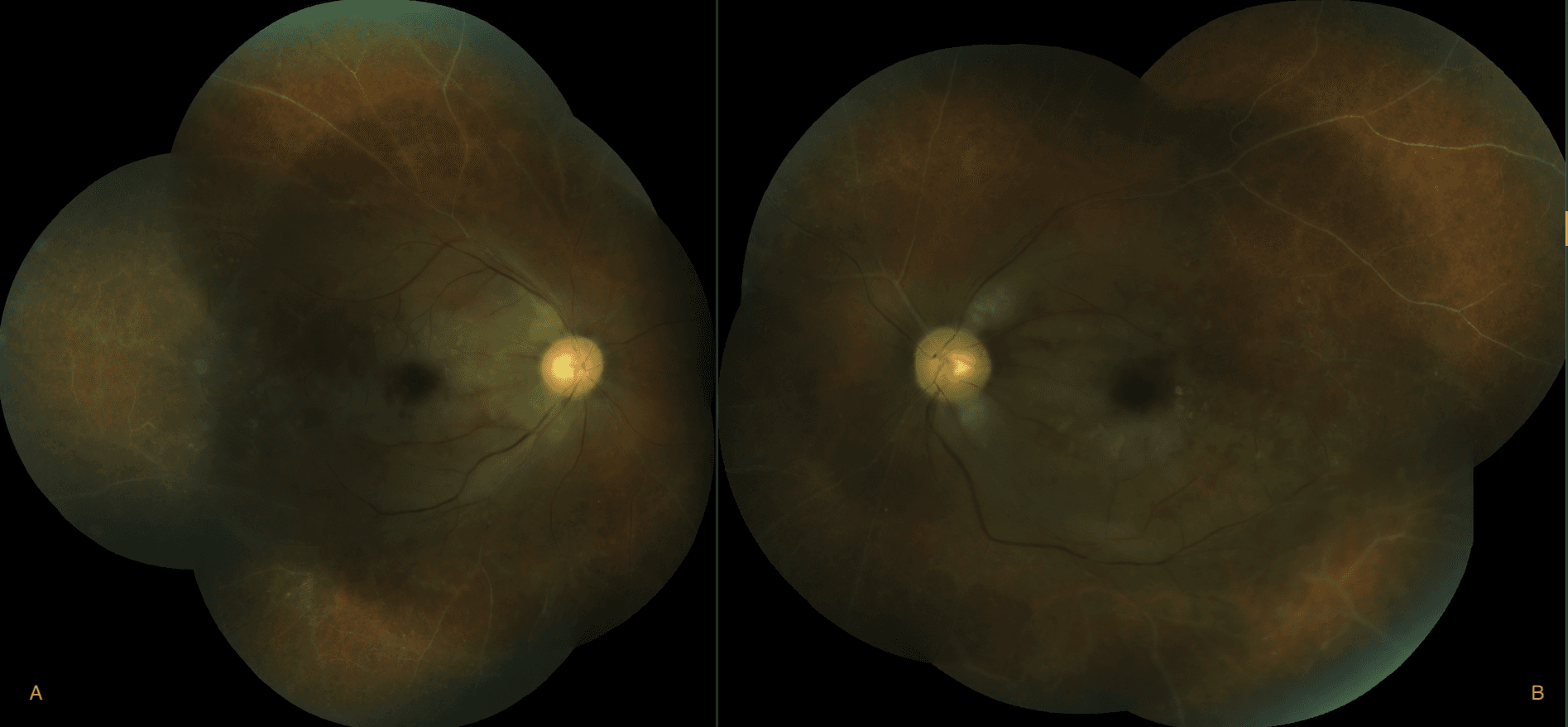 Ophthalmology Case Report: Simultaneous Bilateral Central Retinal ...