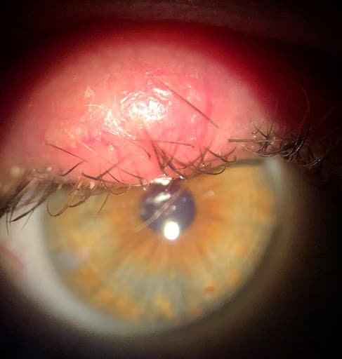 The Ultimate Guide To Demodex Blepharitis