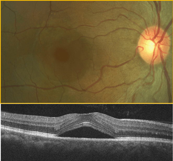 A Complete Guide to the Clarus 500 Ultra-widefield Retinal Camera