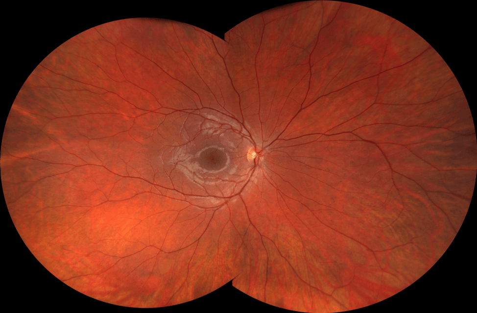 A Complete Guide to the Clarus 500 Ultra-widefield Retinal Camera