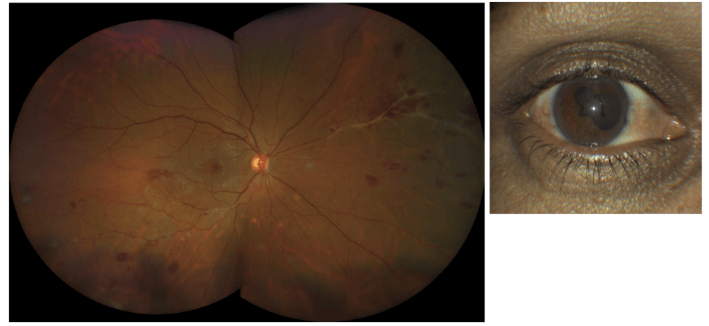 A Complete Guide to the Clarus 500 Ultra-widefield Retinal Camera