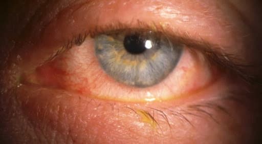 The Ultimate Guide to Conjunctivitis Differential Diagnosis