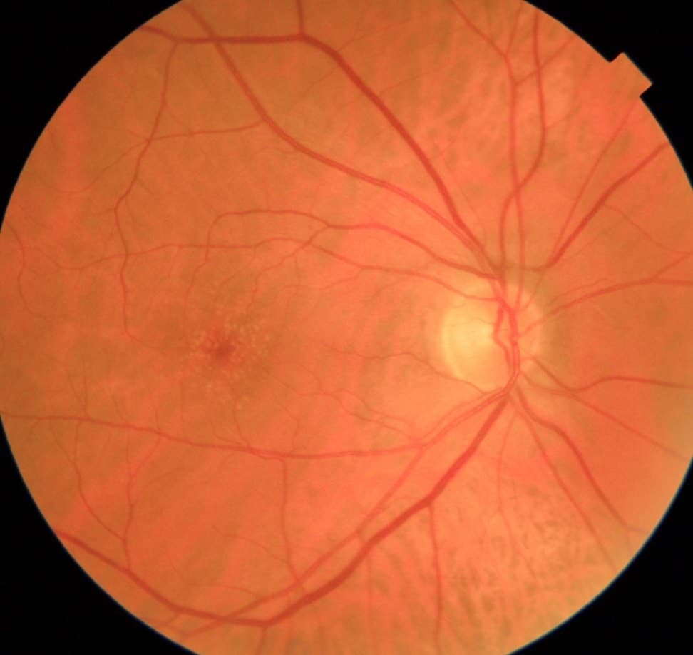 An Introduction to Wet Macular Degeneration for Ophthalmology Residents