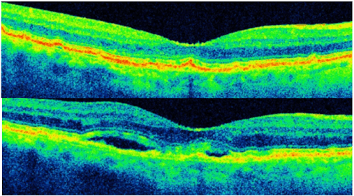 Guide to Common Macula Findings with OCT with Downloadable Cheat Sheet