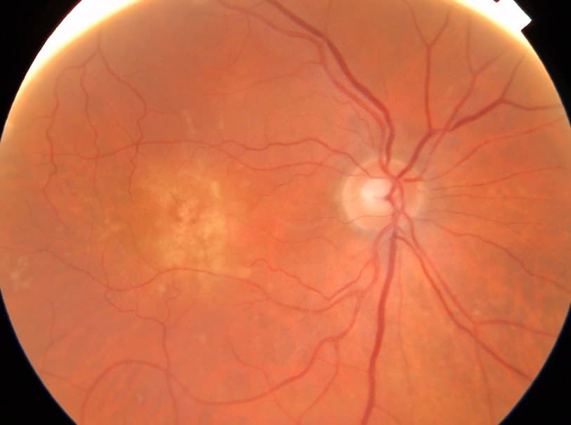 An Introduction to Wet Macular Degeneration for Ophthalmology Residents