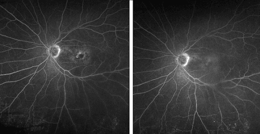 An Optometrist’s Guide to Fluorescein Angiography