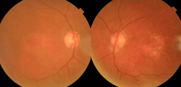 Age-Related Macular Degeneration: A Preamble