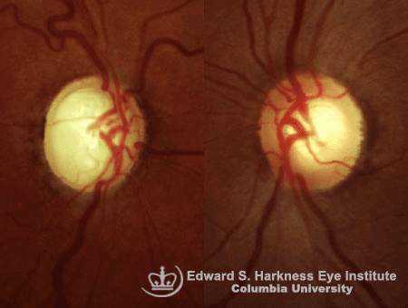 How We Do Retina Screenings in Our Optometry Office