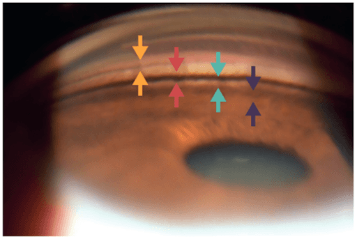 How to Co-Manage Narrow Angle Patients with an Ophthalmologist (with ...
