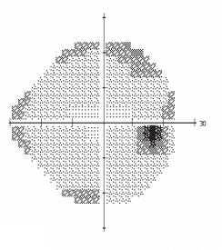 An Optometrist’s Refresher on Visual Field Indices