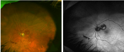 An Optometrist’s Guide to Fluorescein Angiography