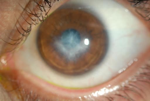 Sight After Hydrop: One Cornea's Journey