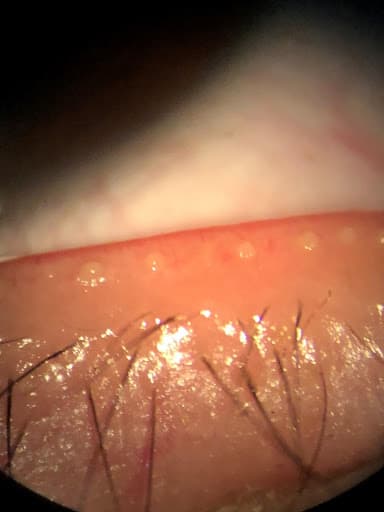 The Ultimate Guide to Demodex Blepharitis
