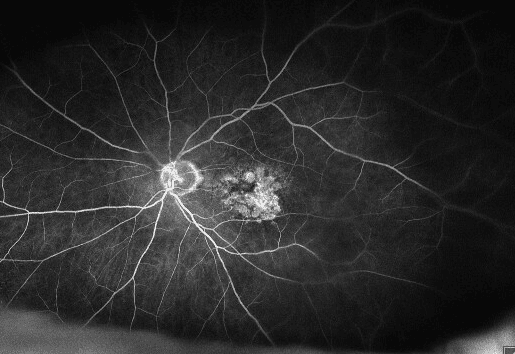 An Optometrist’s Guide to Fluorescein Angiography