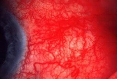 Conjunctivitis, Episcleritis, Scleritis, Oh My! with Differential ...