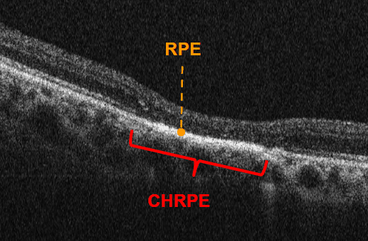 A Complete List of Ocular Diseases with Optical Coherence Tomography (OCT)