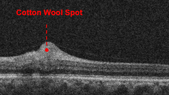 A Complete List of Ocular Diseases with Optical Coherence Tomography (OCT)
