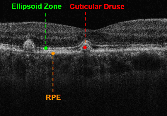 A Complete List of Ocular Diseases with Optical Coherence Tomography (OCT)