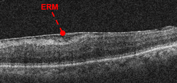 A Complete List of Ocular Diseases with Optical Coherence Tomography (OCT)