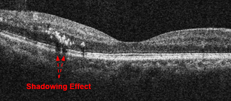 A Complete List of Ocular Diseases with Optical Coherence Tomography (OCT)