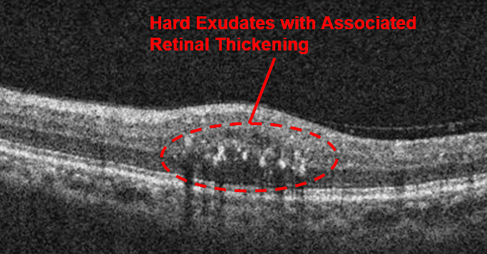 A Complete List of Ocular Diseases with Optical Coherence Tomography (OCT)