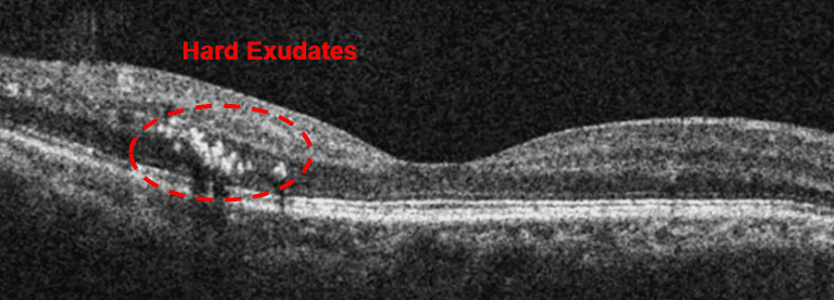 A Complete List of Ocular Diseases with Optical Coherence Tomography (OCT)