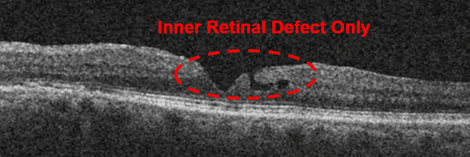 A Complete List of Ocular Diseases with Optical Coherence Tomography (OCT)
