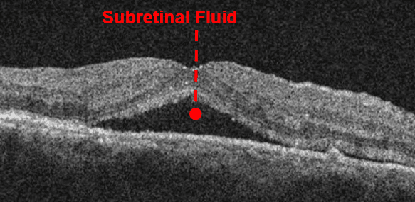 A Complete List of Ocular Diseases with Optical Coherence Tomography (OCT)