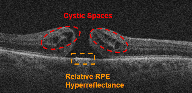 A Complete List of Ocular Diseases with Optical Coherence Tomography (OCT)