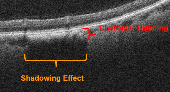 A Complete List of Ocular Diseases with Optical Coherence Tomography (OCT)