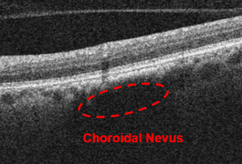 A Complete List of Ocular Diseases with Optical Coherence Tomography (OCT)
