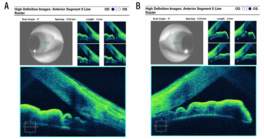 How to Co-Manage Narrow Angle Patients with an Ophthalmologist (with ...