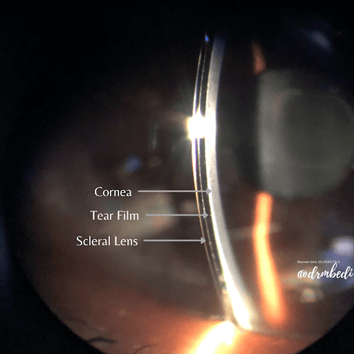 Ocular Disease & Specialty Contact Lenses: A Study Guide