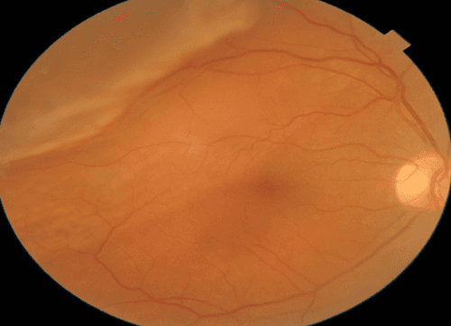 An Introduction to Metamorphopsia Following Retinal Detachment Repair ...