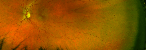 How Ultra-Widefield Imaging Can Boost Your Practice and Benefit Your ...